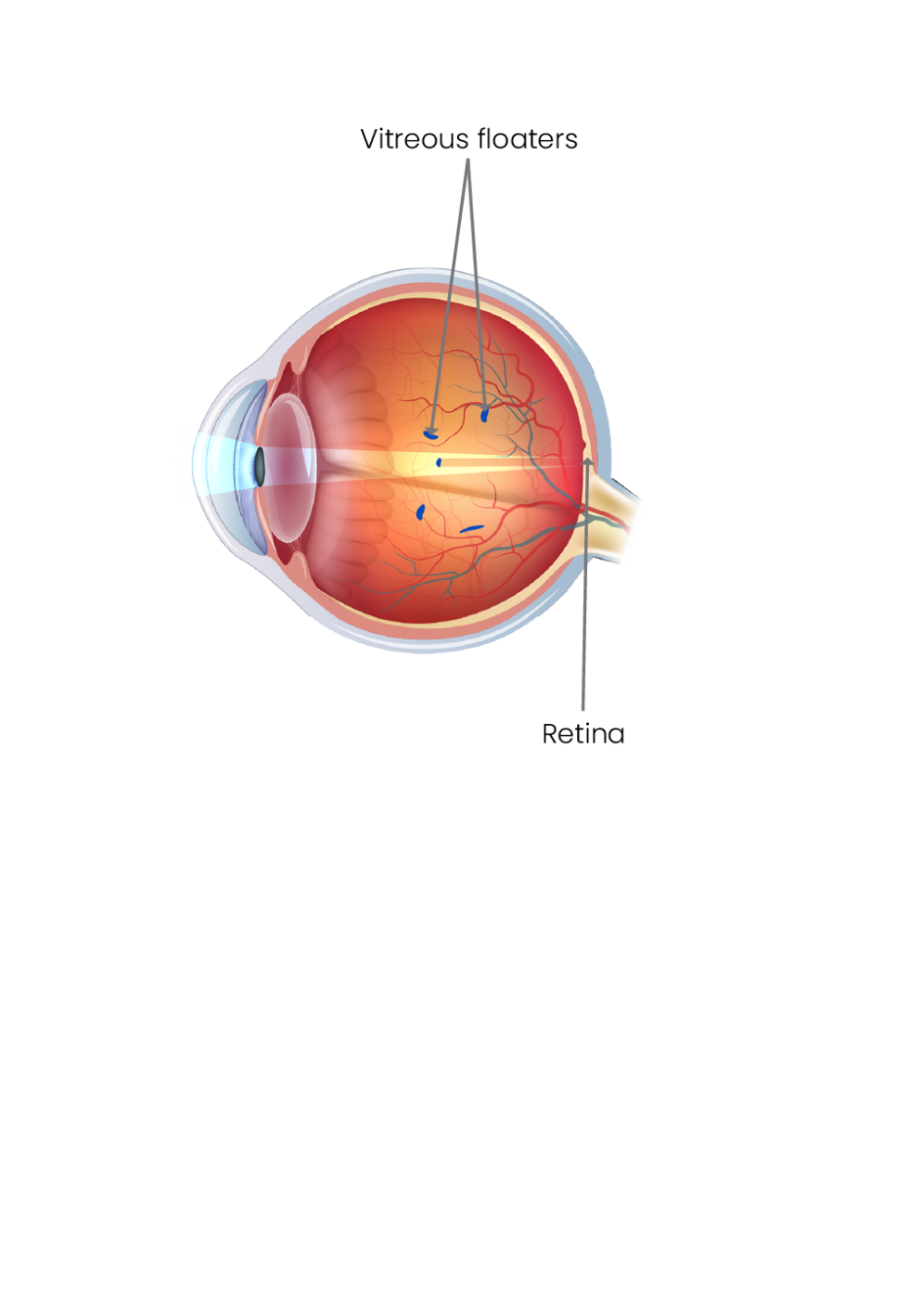 Flashes and Floaters - Ophthalmologist Brisbane - Eye Doctor Brisbane ...