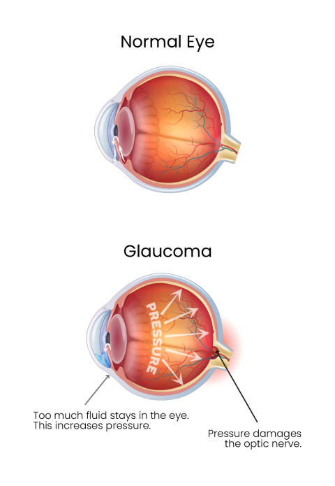 Glaucoma Surgery Brisbane – The Eye Health Centre