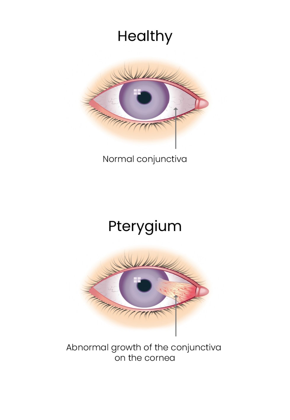 Pterygium Brisbane – The Eye Health Centre