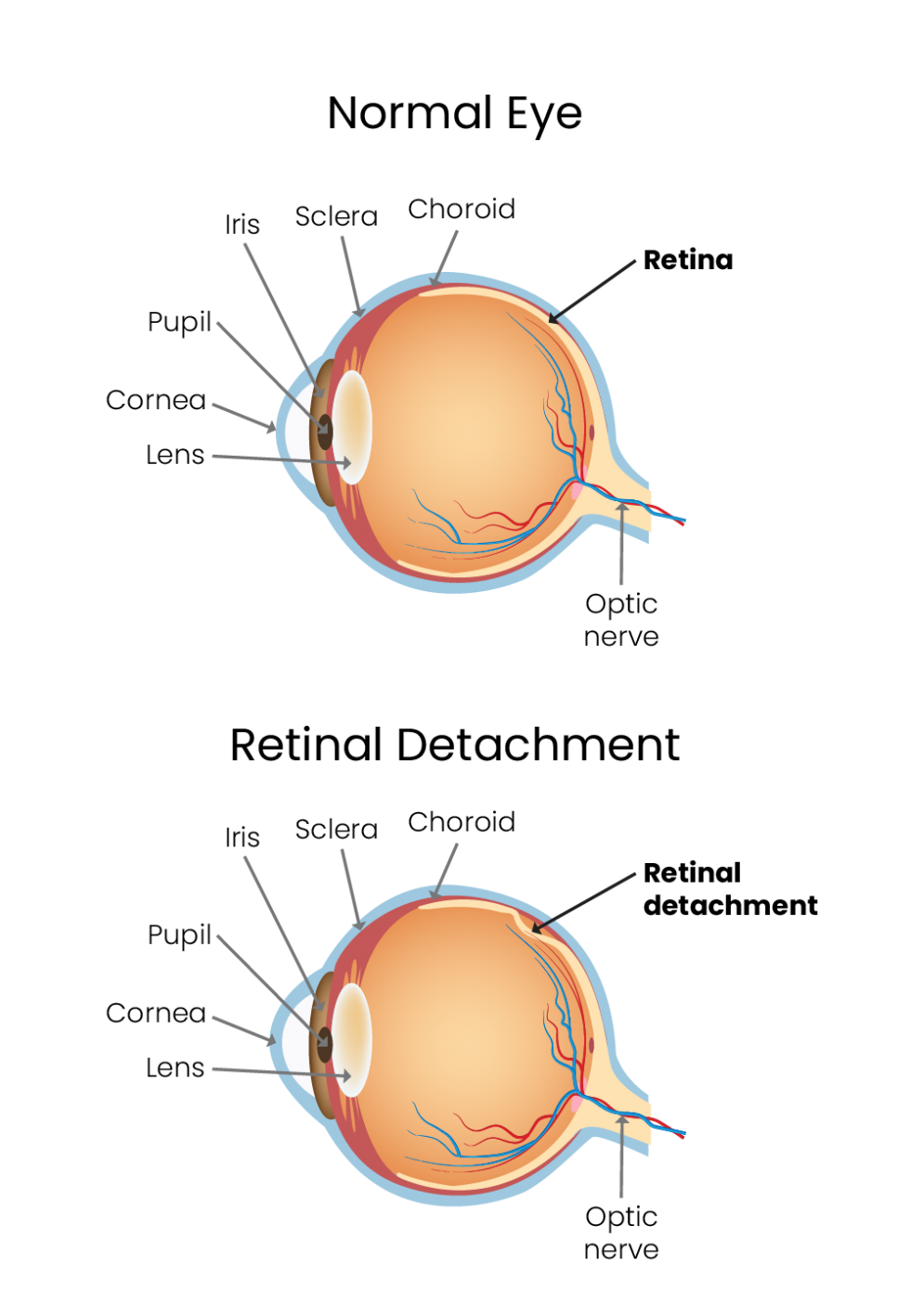 Retinal Detachment Treatment | The Eye Health Centre