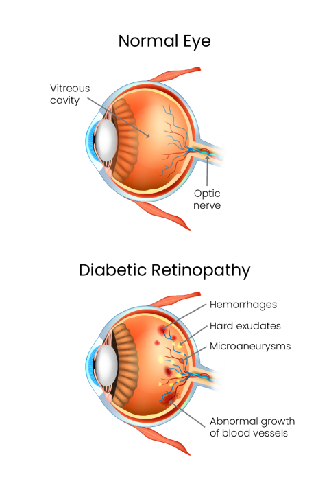 Retinal Vascular Disease | Ophthalmologist Brisbane - Eye Doctor Brisbane | The Eye Health Centre