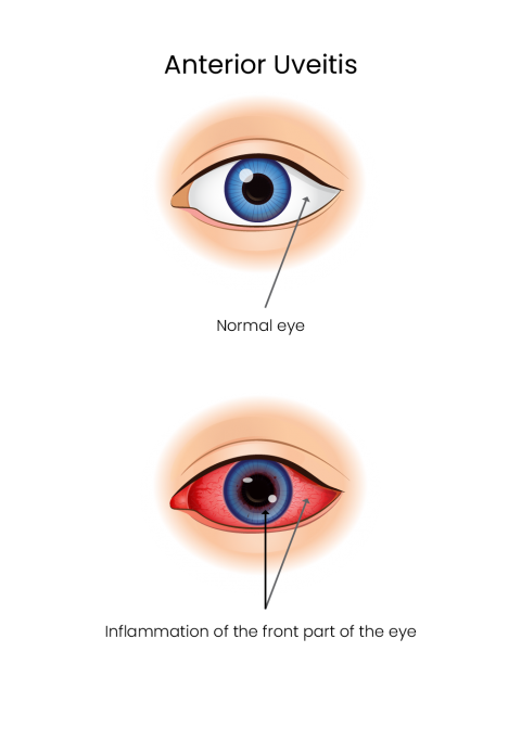 Uveitis - Ophthalmologist Brisbane | The Eye Health Centre